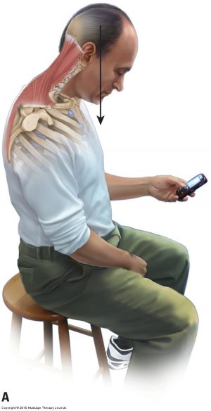 Tension Headaches - Musculoskeletal Condition of the Neck