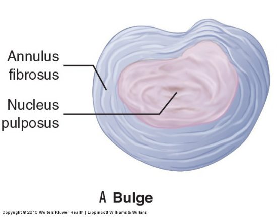 Pathologic Disc Conditions of the Lumbar Spine and Sciatica