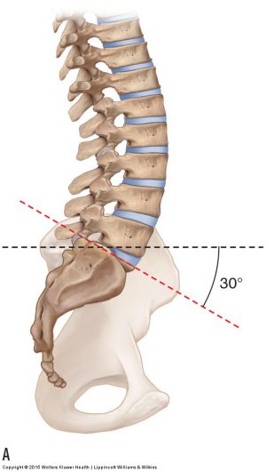 Lower Crossed Syndrome postural distortion pattern