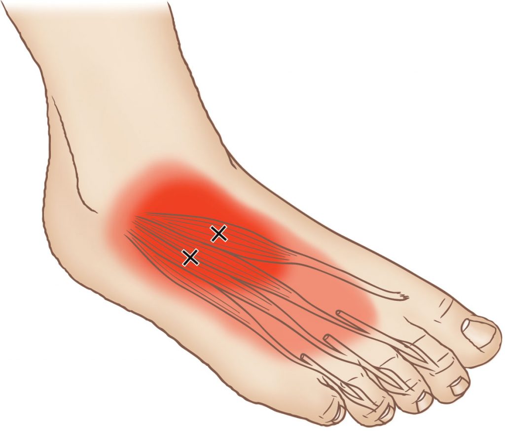Extensors digitorum and hallucis brevis - Trigger Point - Learn Muscles