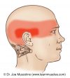 Suboccipital Group - Trigger Points - Learn Muscles