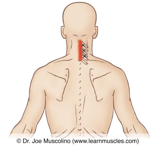 Rotatores (Cervical) - Trigger Points - Learn Muscles