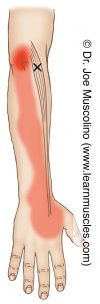 Extensor Carpi Radialis Longus - Trigger Points - Learn Muscles