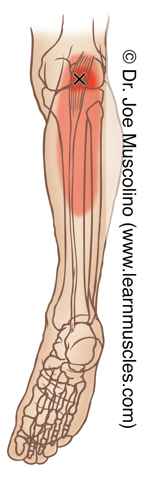 Plantaris - Trigger Points - Learn Muscles