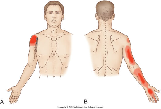 Coracobrachialis: Attachments, Functions, Palpation & Treatment
